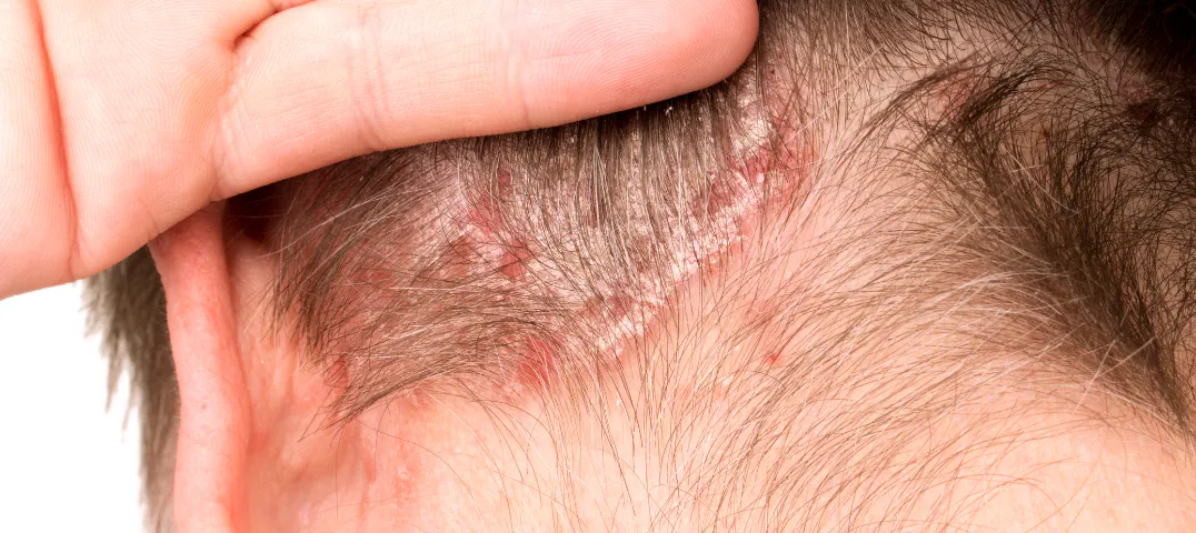 Treating Plaque Psoriasis from the Inside Out