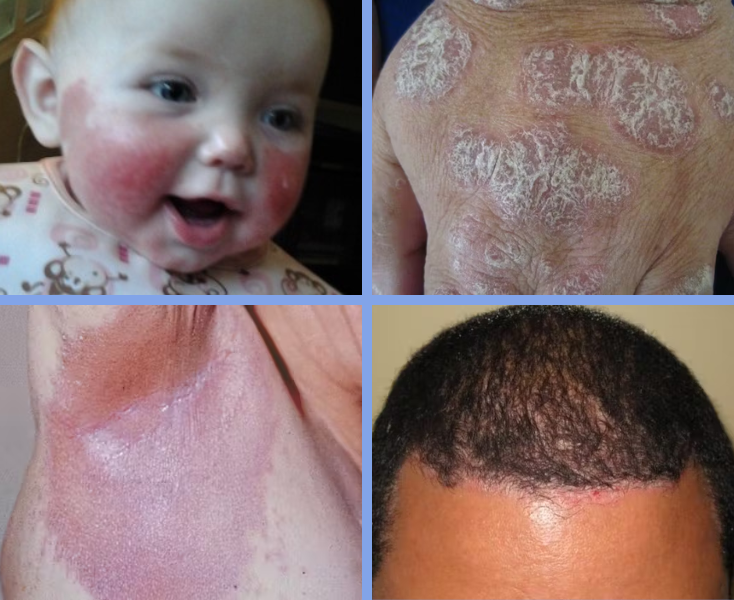 Reassessing Psoriasis Severity