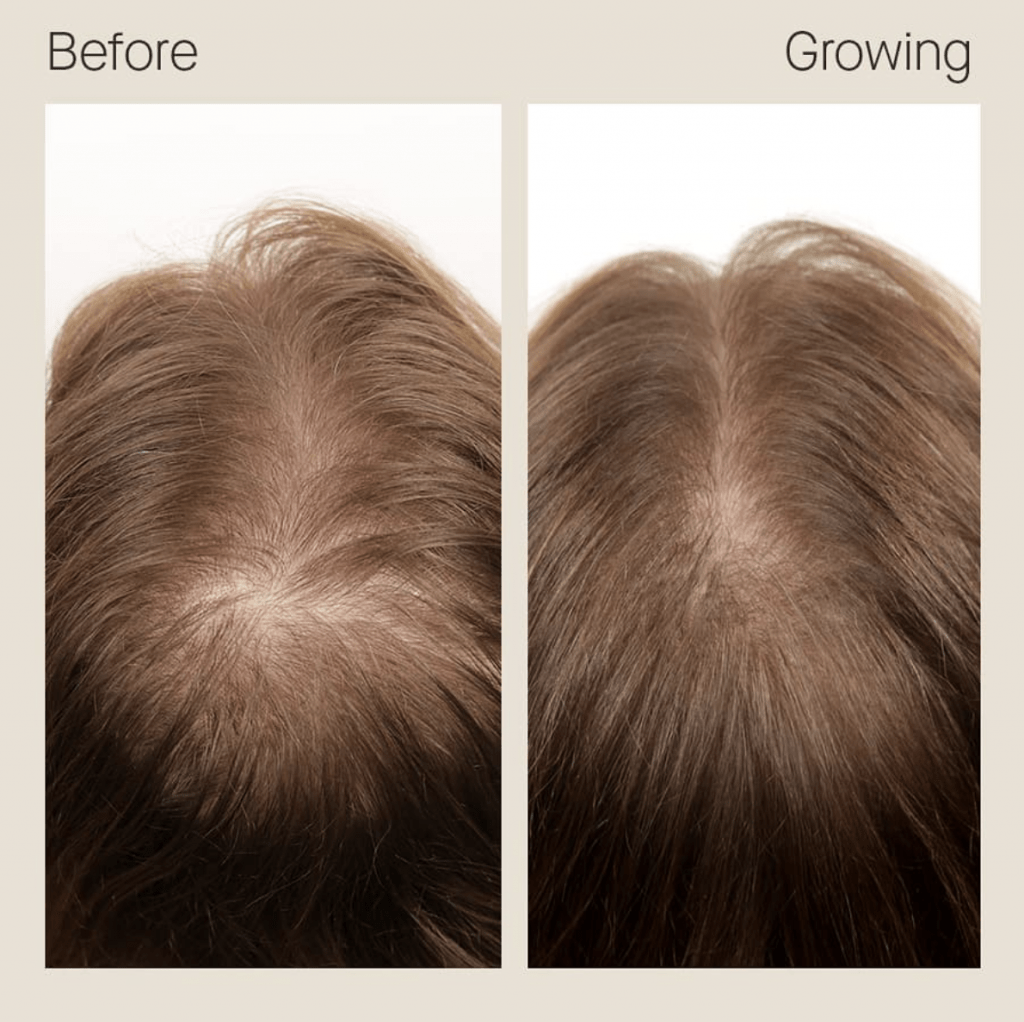 Nutrafol Before And After Pics