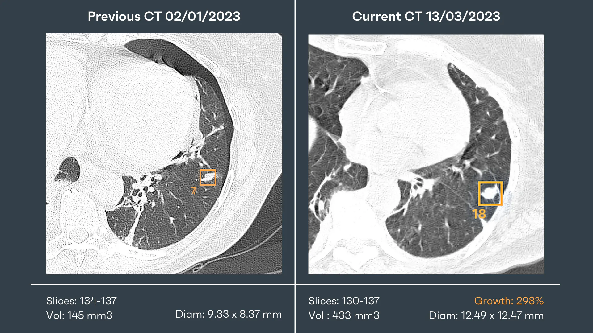 Lung Cancer Screening with AI: Benefits and Challenges