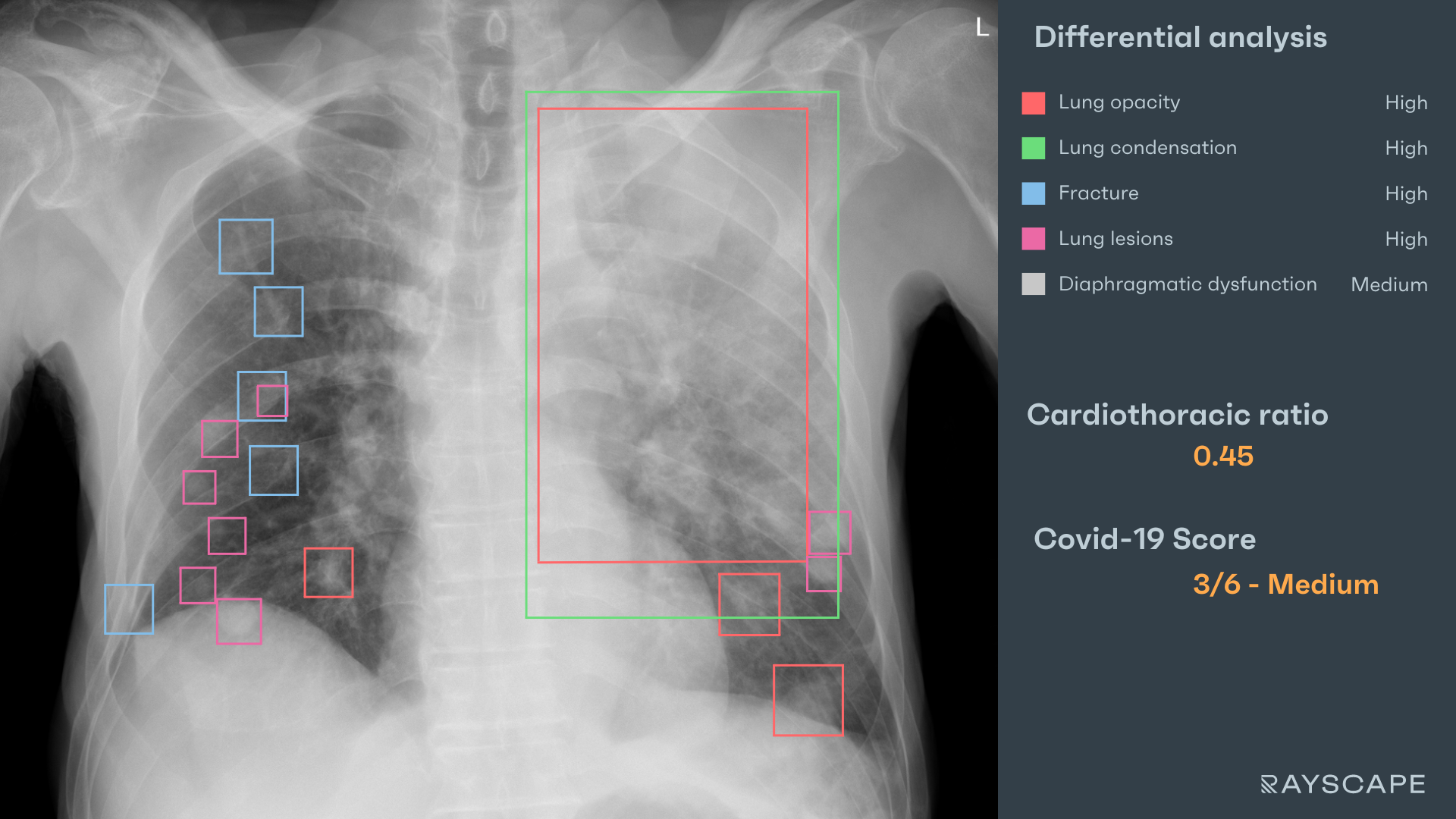 Acute Respiratory Insufficiency & Lung Metastasis: An AI approach