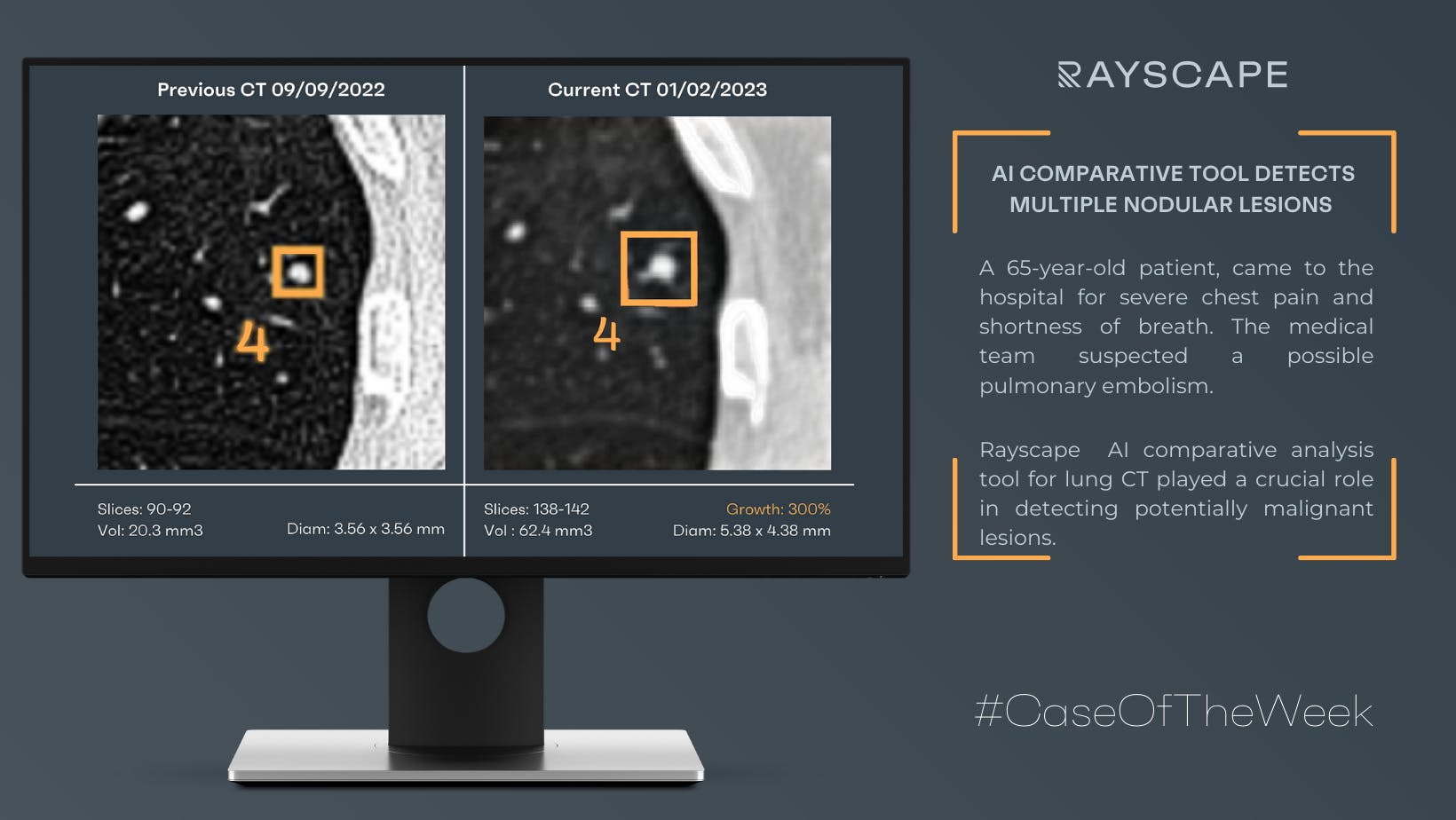 Lung Cancer Screening with AI: Benefits and Challenges