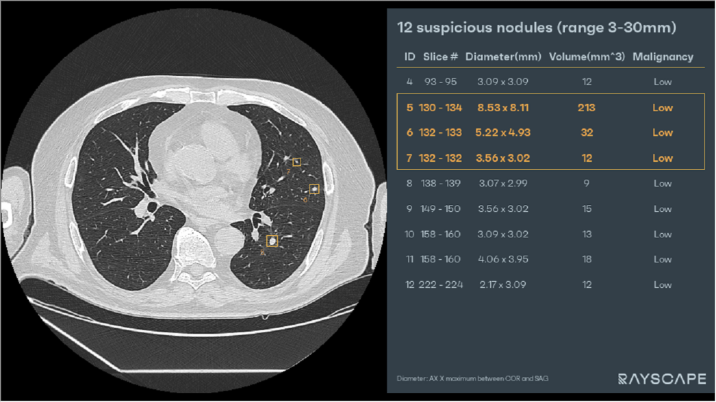 Rayscape | Lung CT