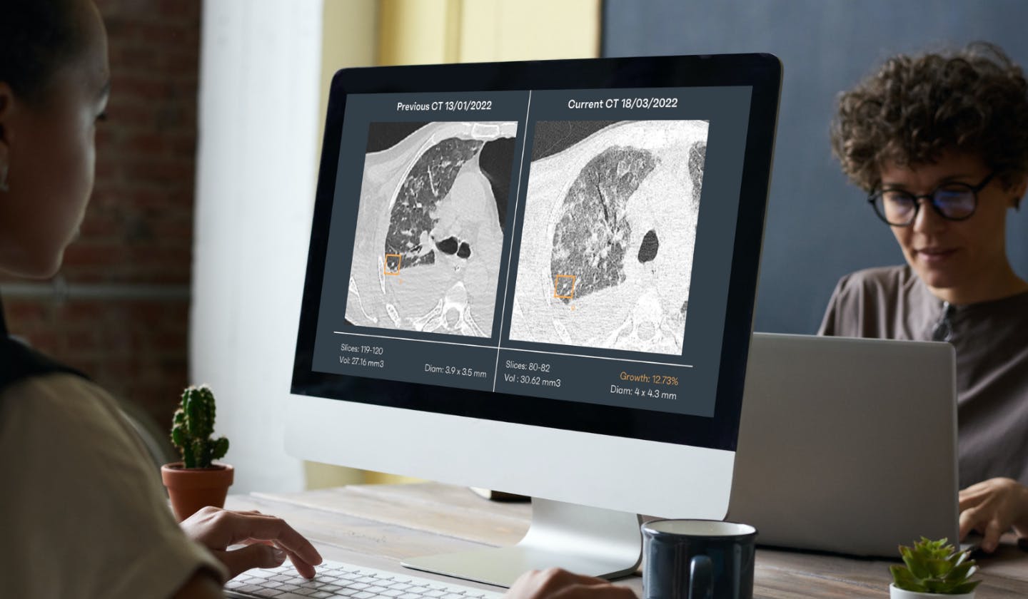 Lung Cancer Screening with AI: Benefits and Challenges