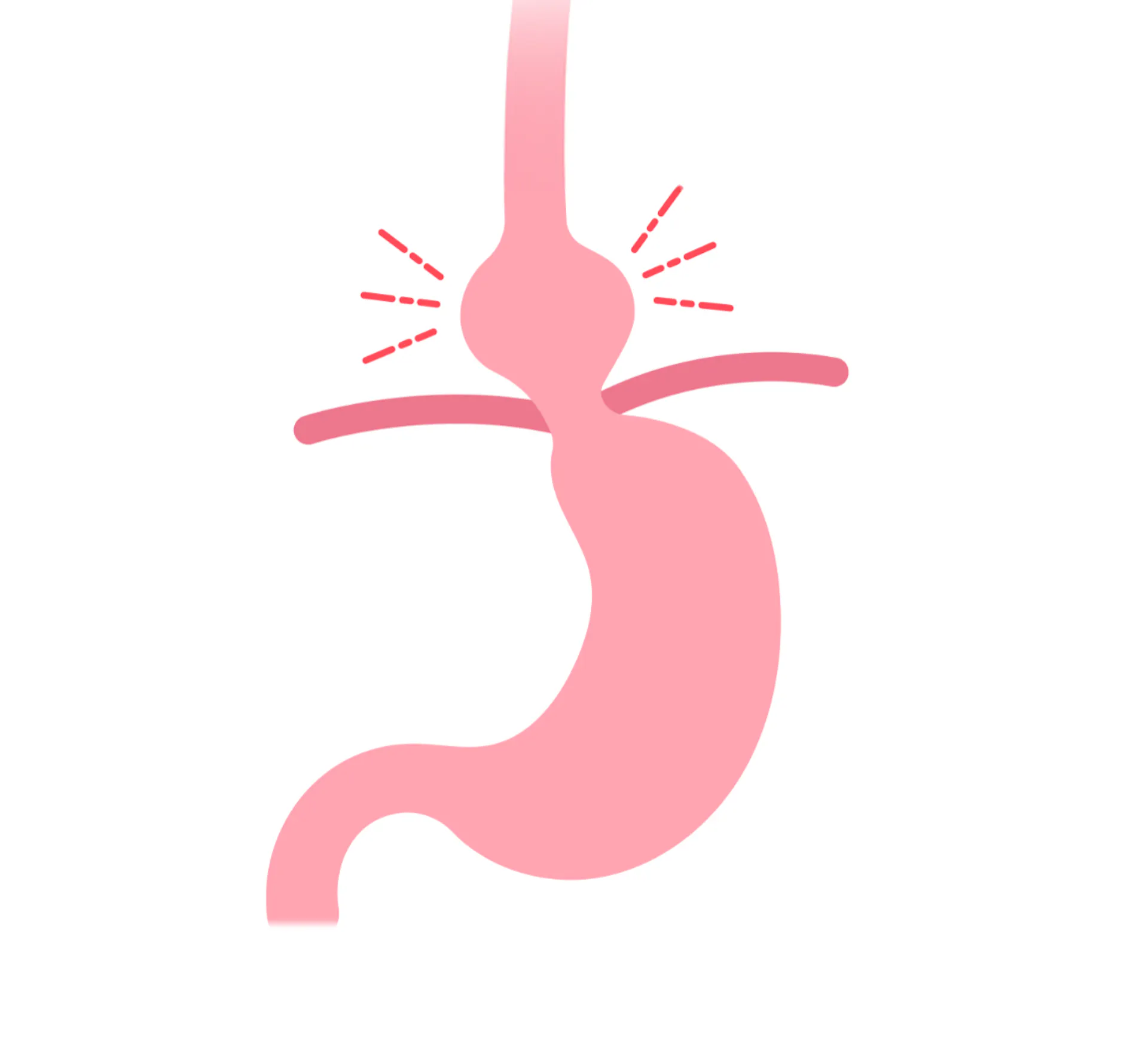 Hiatus Hernias | Sliding, Rolling | Treatment - RefluxUK