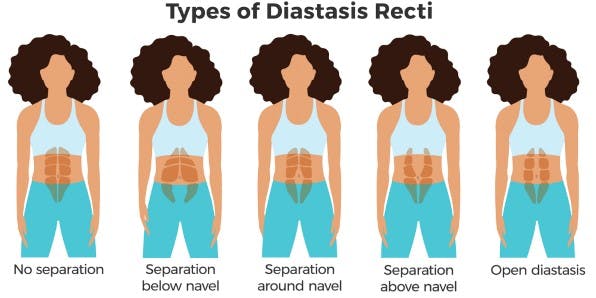 Running with Diastasis Recti | SportsShoes.com