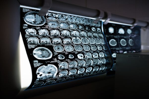 Eating-Disorders-and-Acquired-Brain-Injury | Switalskis