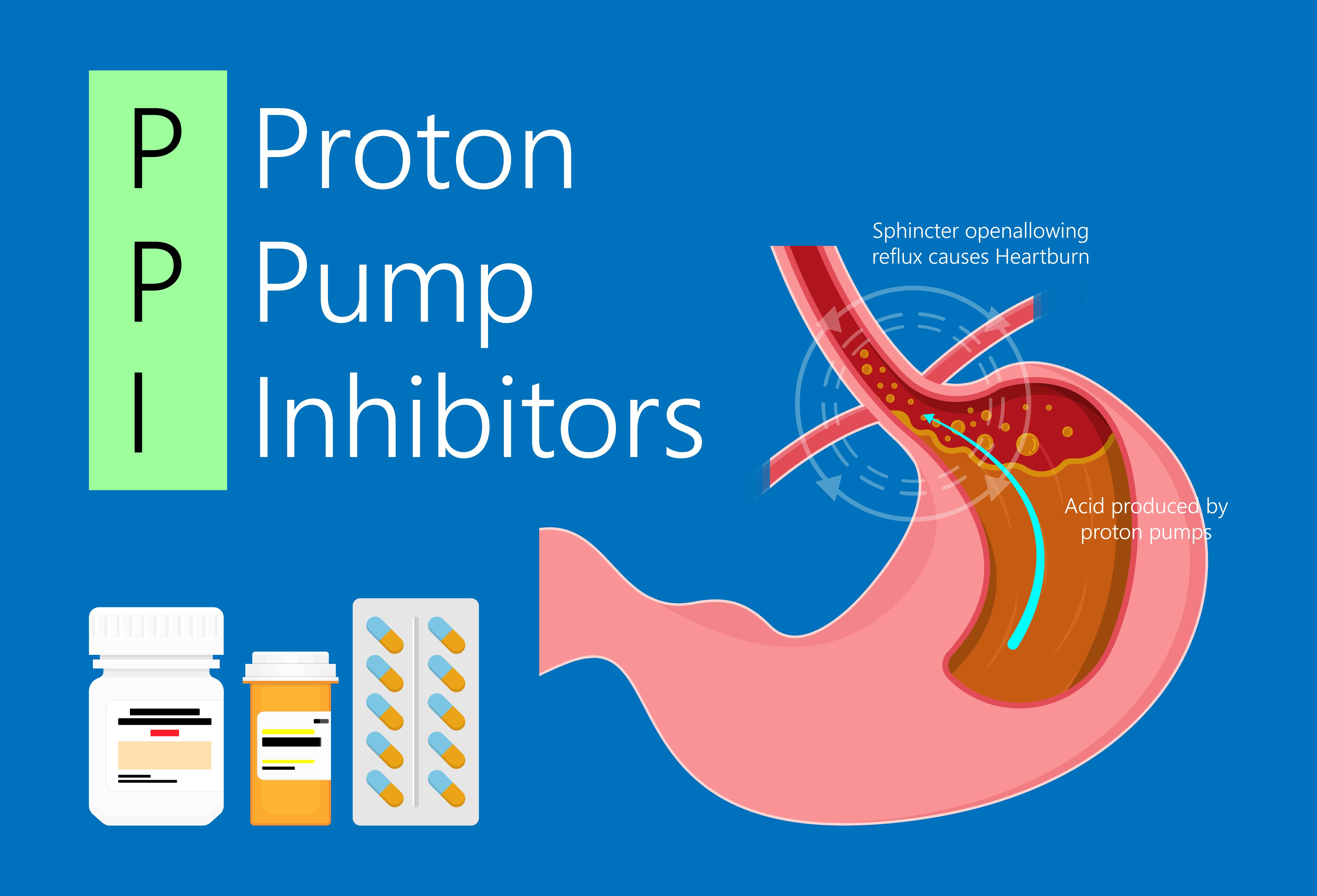 Proton pump inhibitors (PPIs) for stomach ulcer