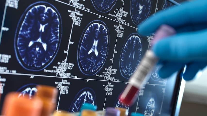 Alzheimermedicijn krijgt groen licht voor Europese markt