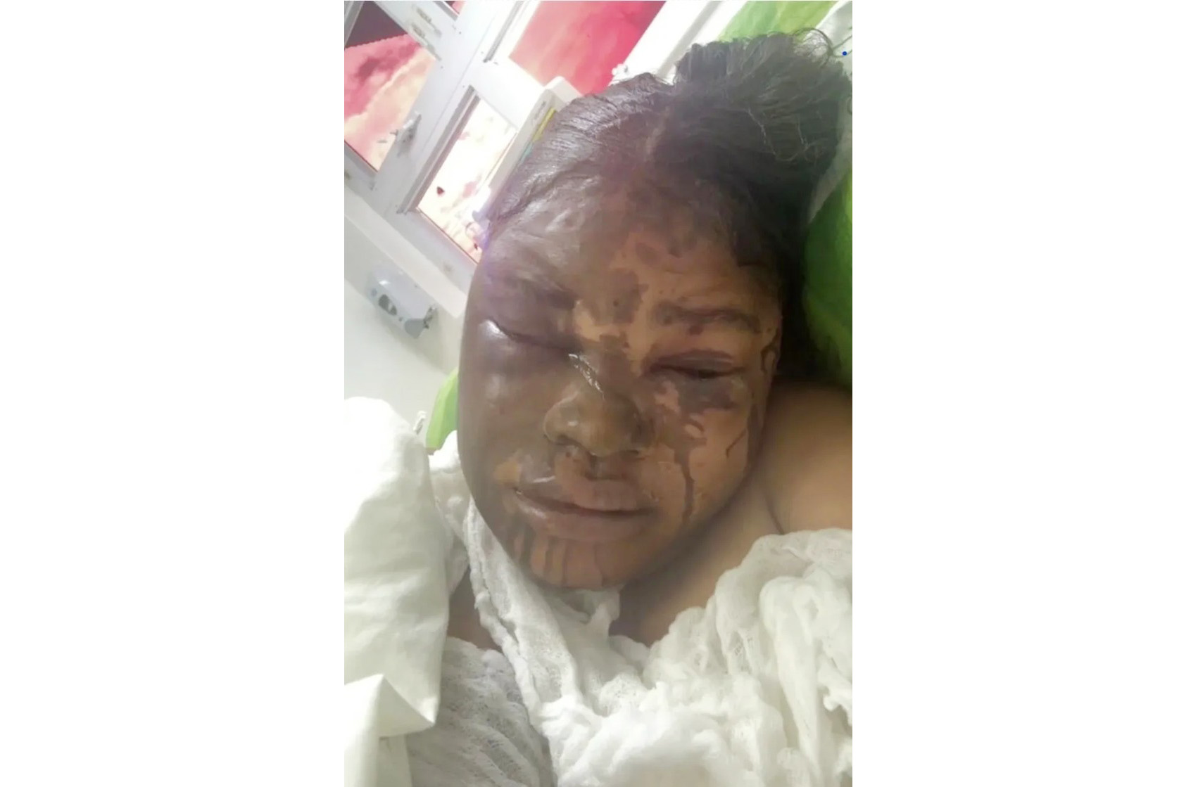 Cops fume as acid attacker walks on bail