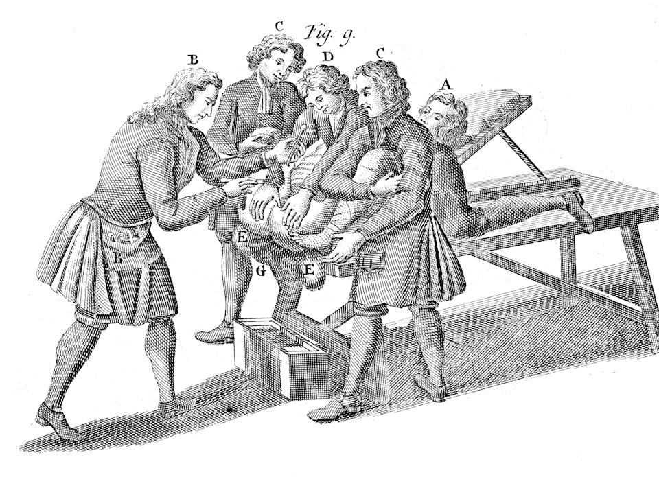 The extraction of the excruciating bladder stones | Wellcome Collection