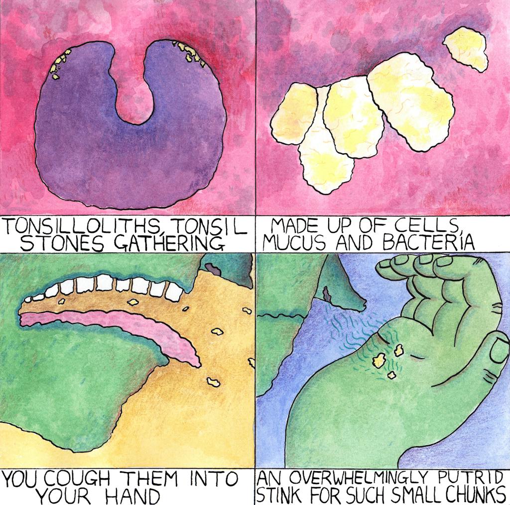 Tonsilloliths | Wellcome Collection