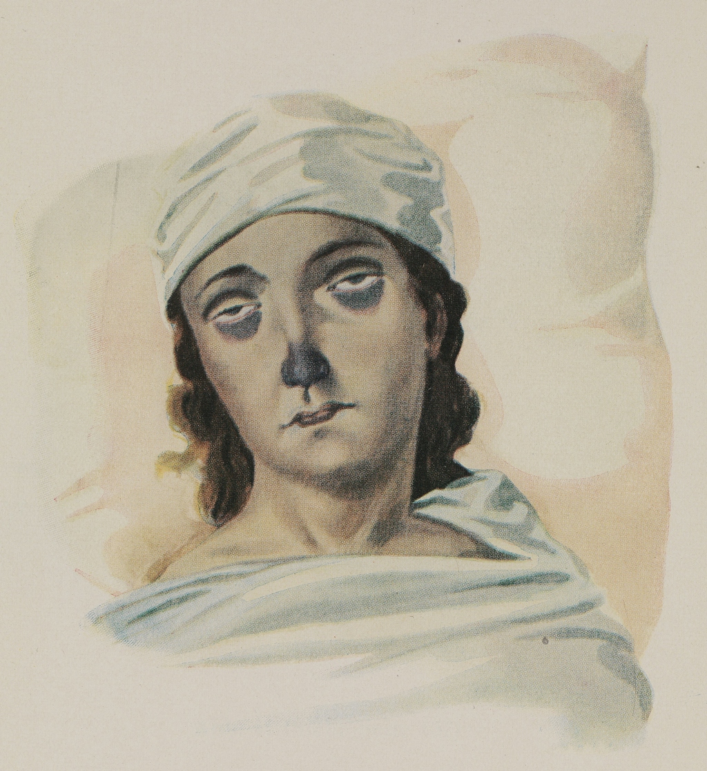 The colonist who faced the blue terror | Wellcome Collection