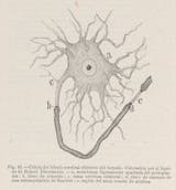 The epilepsy diagnosis | Wellcome Collection
