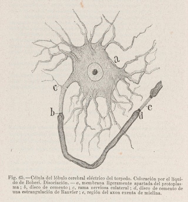 The epilepsy diagnosis | Wellcome Collection
